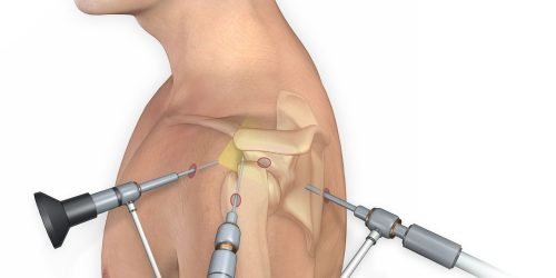Shoulder Arthroscopic Surgeon in JP Nagar - Bone Heal Orthopaedic ...